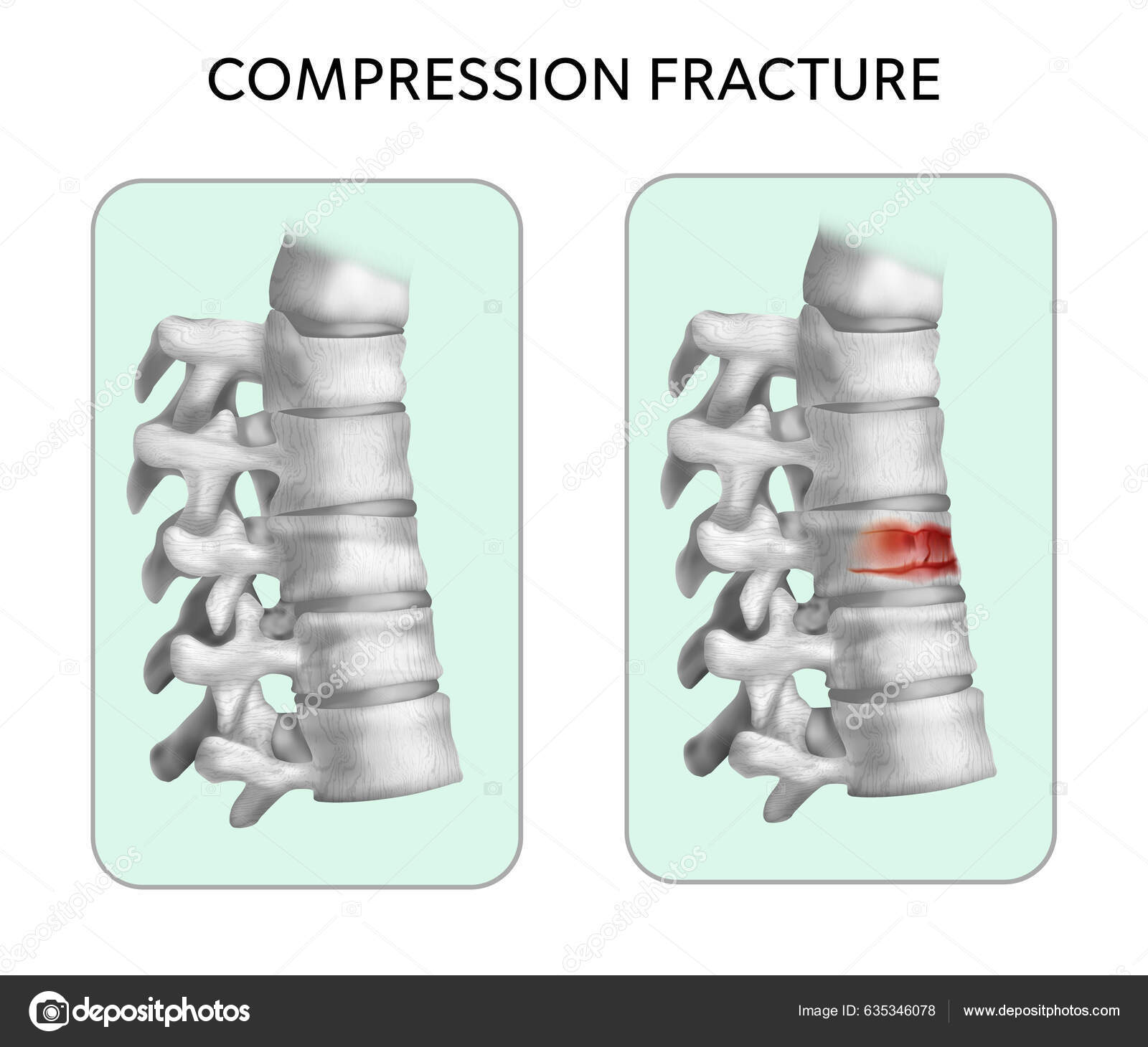Compression Fracture Spine Vector Illustration Vector de stock ...