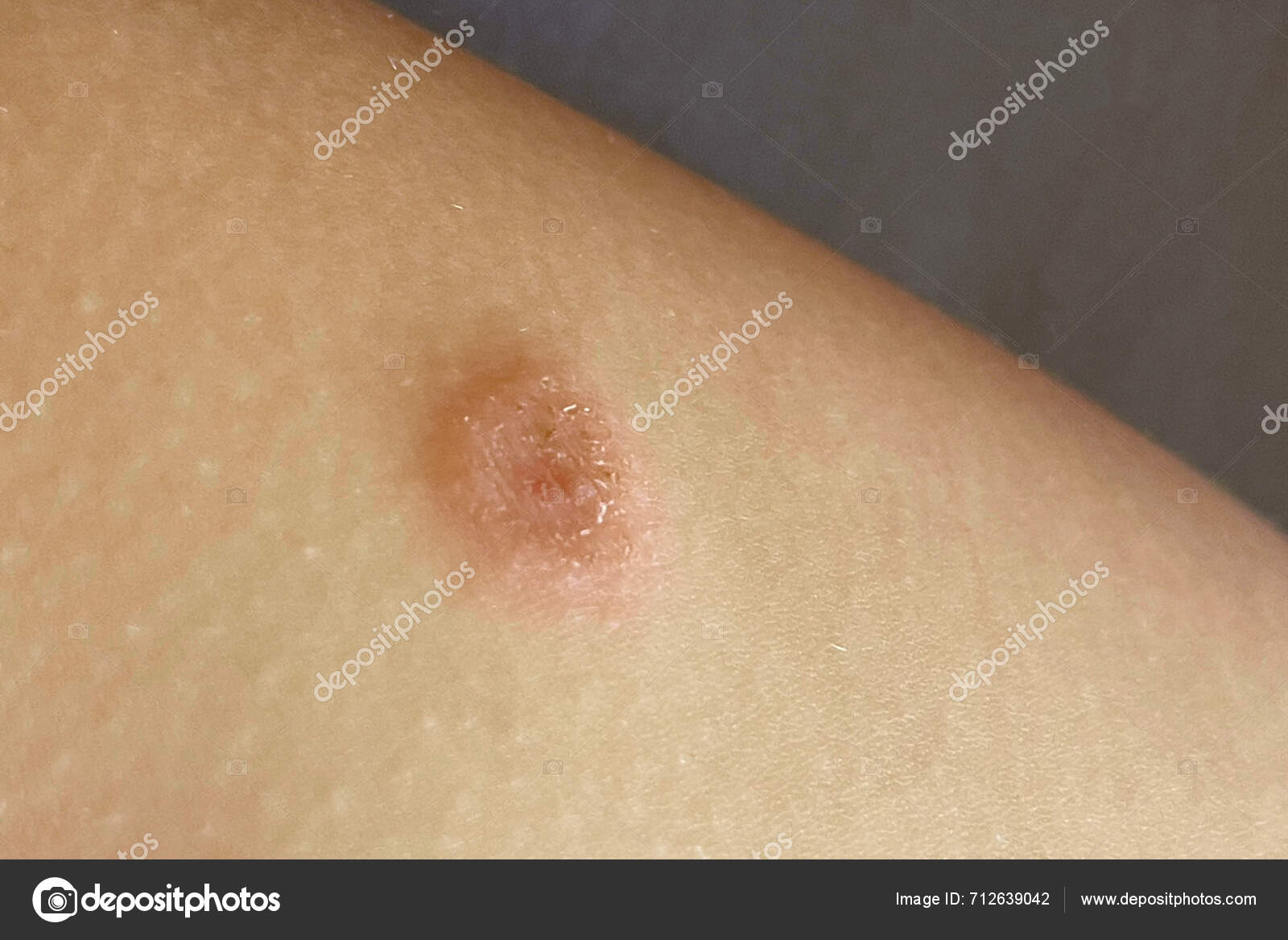 Close Skin Problem Infectious Disease Allergy Dermatitis Virus ...