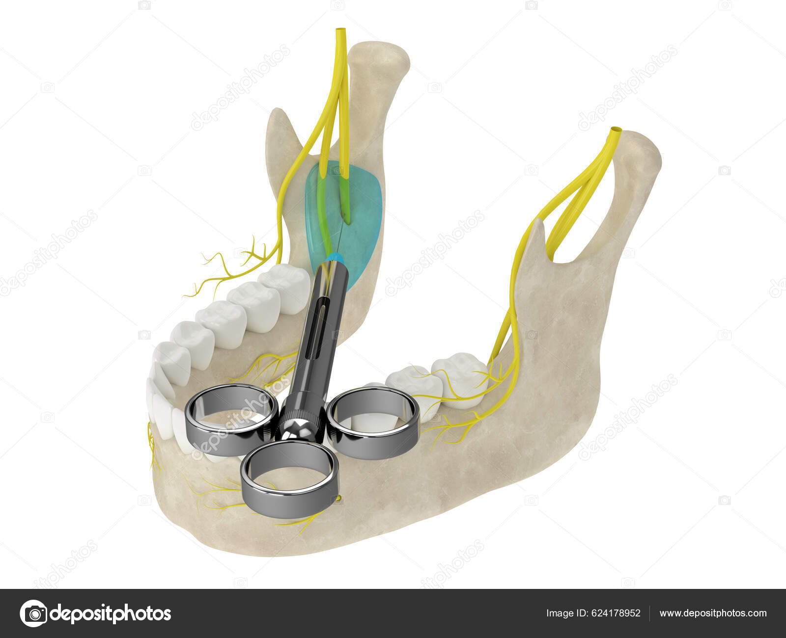 Render Mandibular Arch Inferior Alveolar Nerve Block Types Dental ...