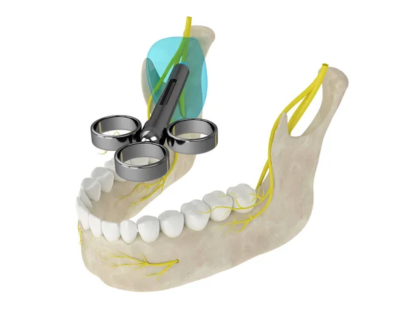 Mandibular Arch Incisive Nerve Block Types Dental Anesthesia Concept ...