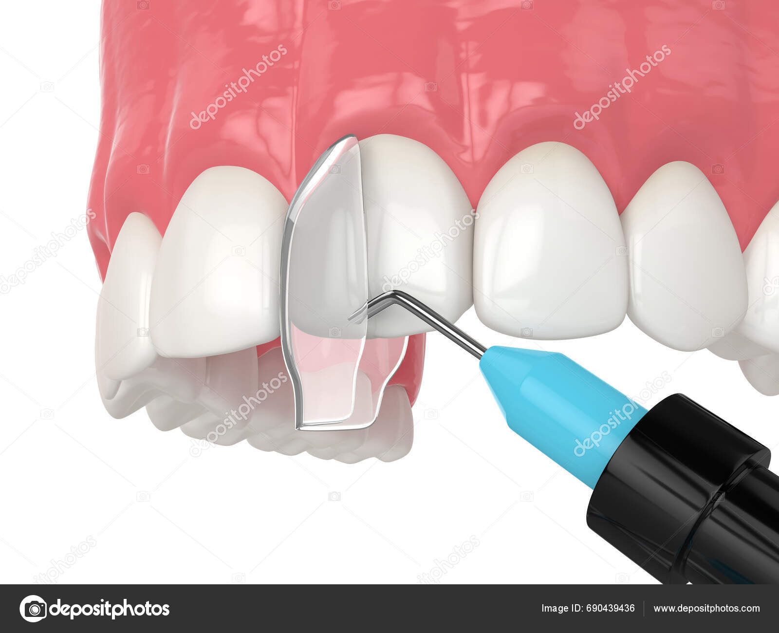 Render Crooked Tooth Treatment Using Bonding Procedure — Stock Photo ...