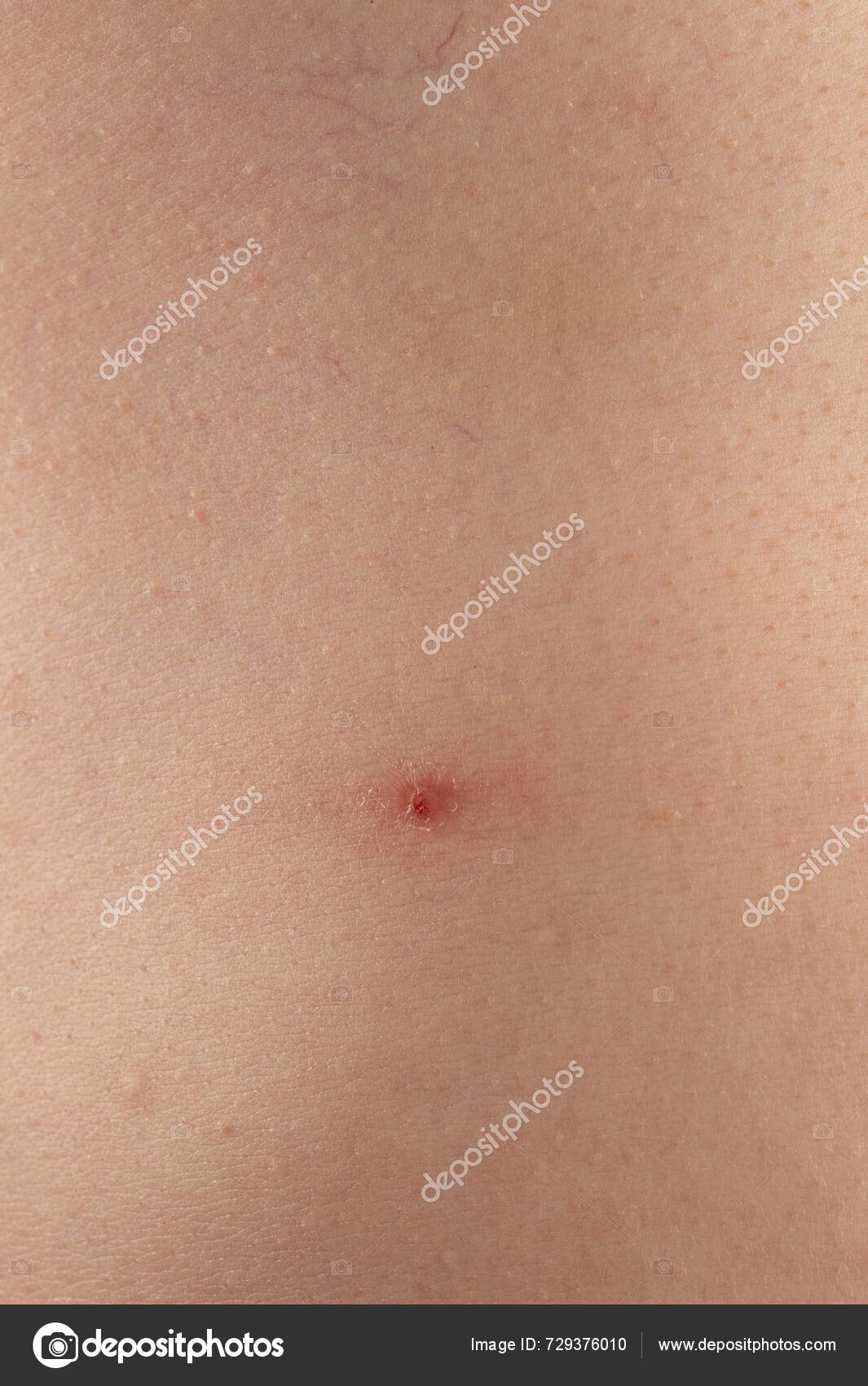Red Spot Human Skin Pimple Skin Problem Theme — Stock Photo © dimarik ...