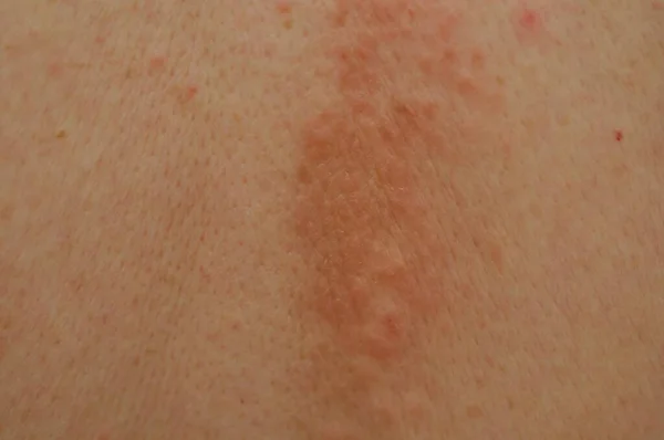 Rash on back Stock Photos, Royalty Free Rash on back Images | Depositphotos