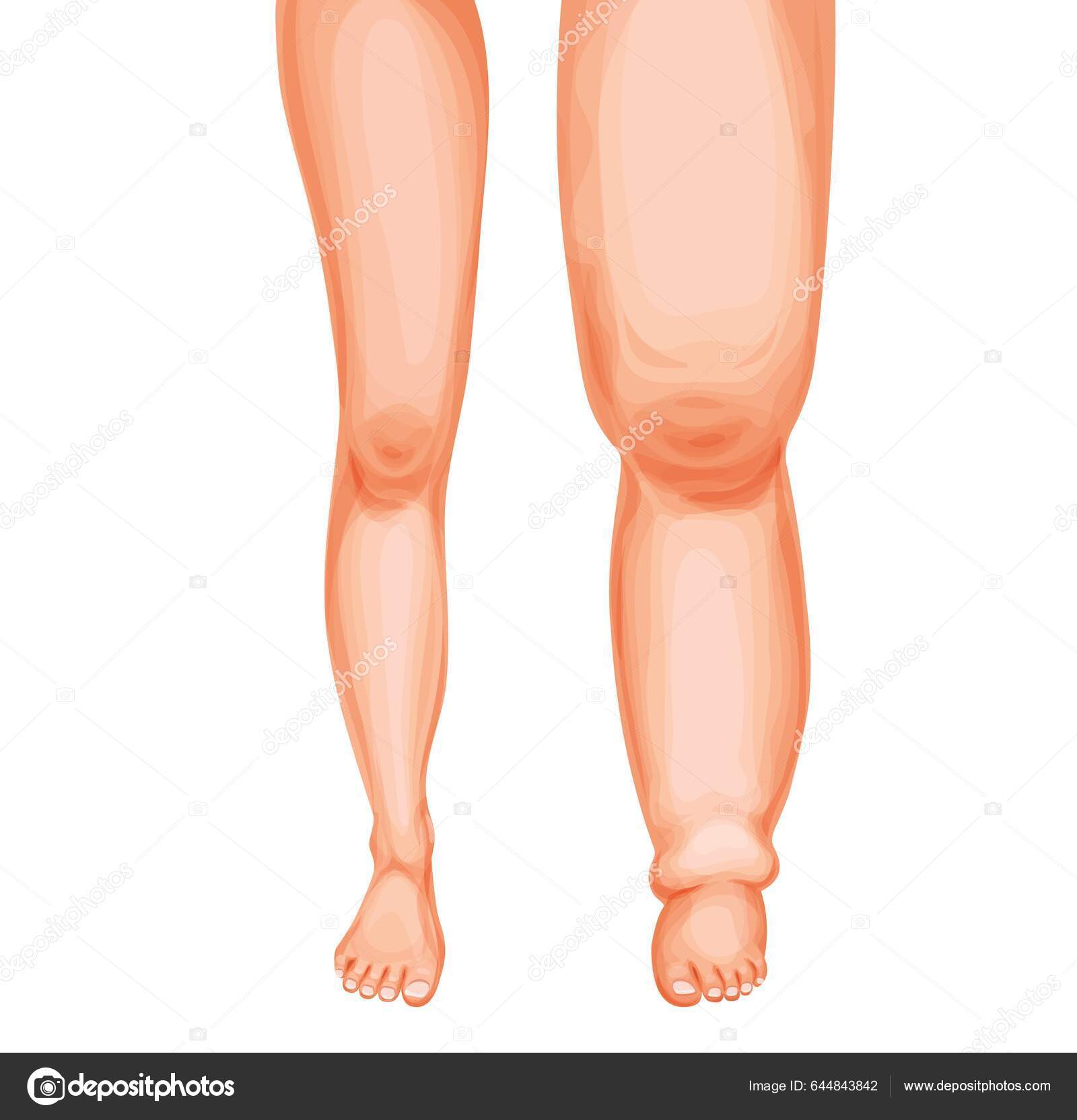 Edema Foot Swollen Leg Ankle Vector Lymphedema Lymphoedema Disease ... Edema Foot Swollen Leg Ankle Vector Lymphedema Lymphoedema Disease ...