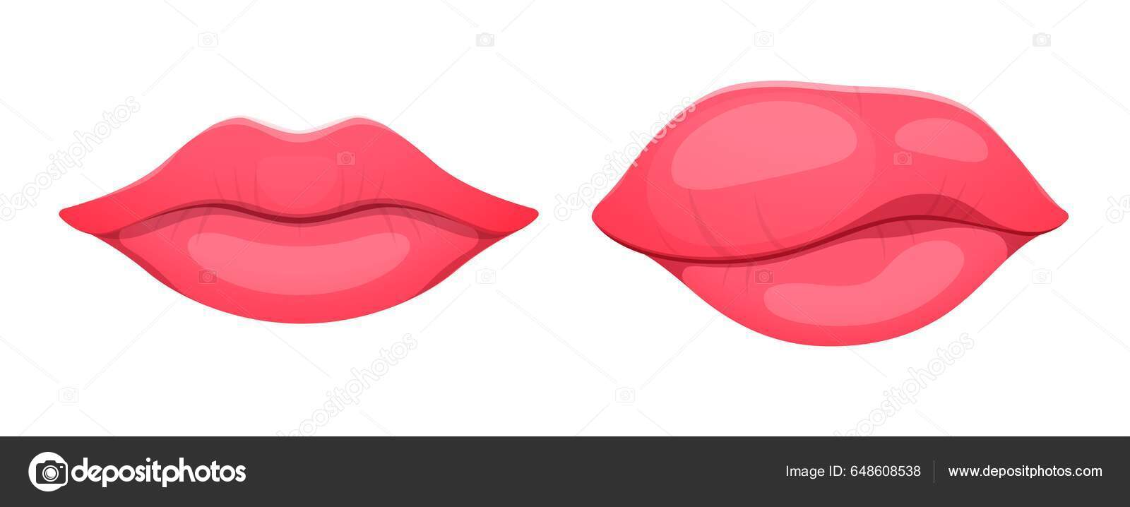 Angioedema Edema Lips Body Tissue Swelling Allergic Syndrome ...