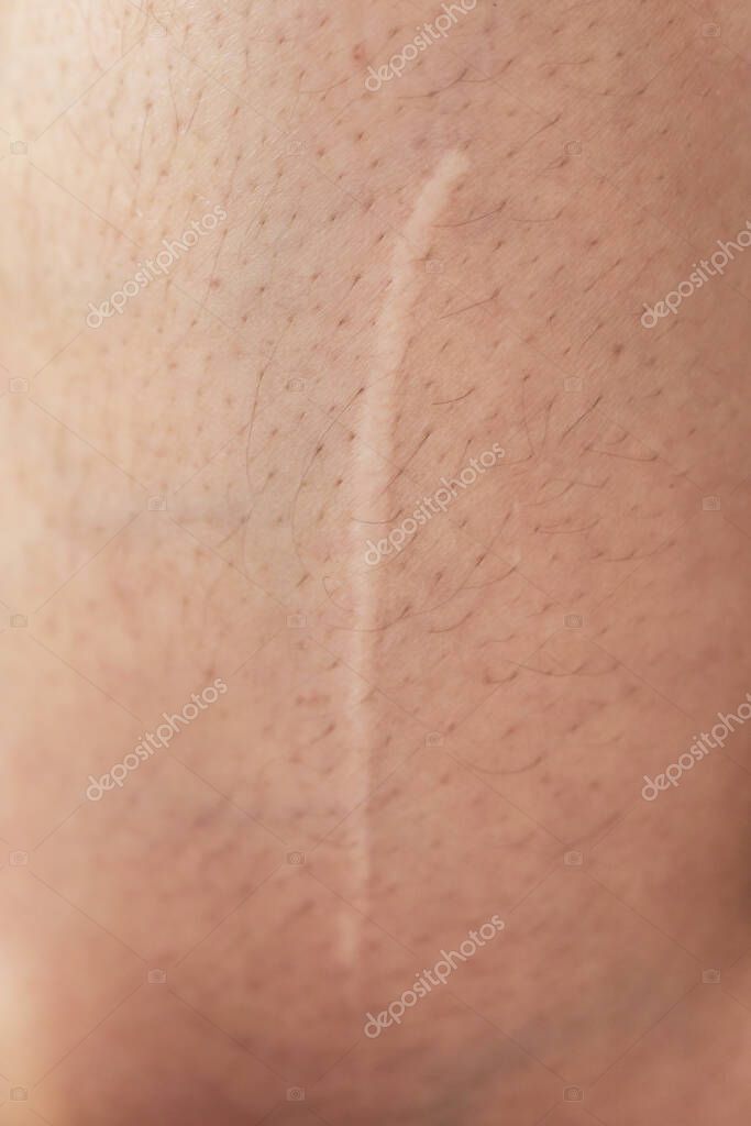 Primer plano de la cicatriz queloide cianótica causada por cirugía y ...