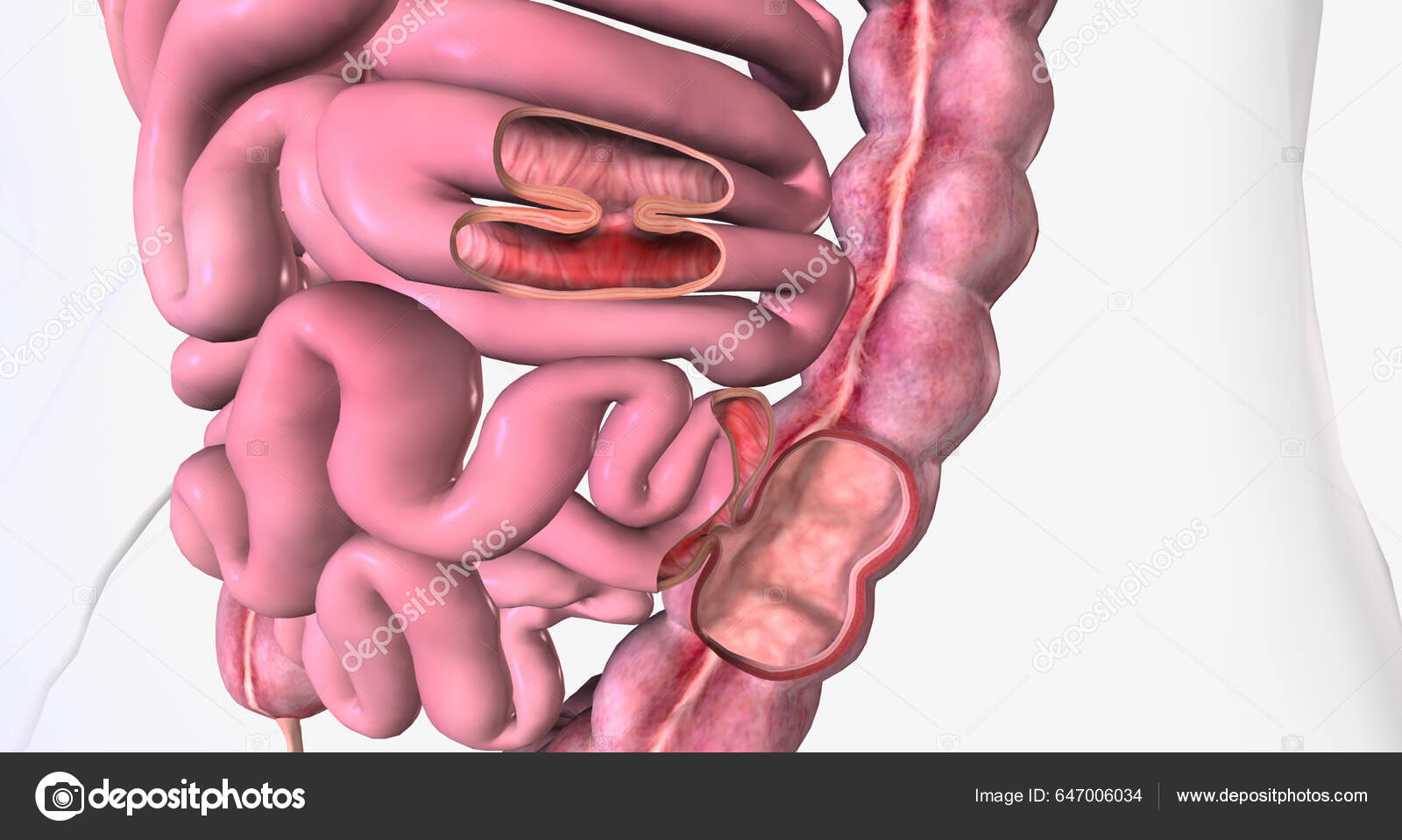 Une Fistule Est Une Connexion Anormale Entre Deux Parties L'intérieur ...