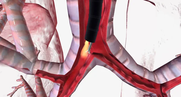 Bronchoscopy Stock Photos, Royalty Free Bronchoscopy Images | Depositphotos