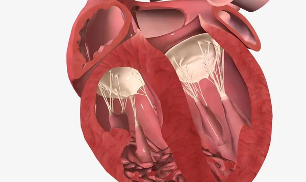 El foramen oval patente (FOP) es un agujero anormal presente en la ...