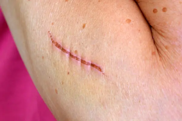 Knee replacement surgery scar Stock Photos, Royalty Free Knee ...