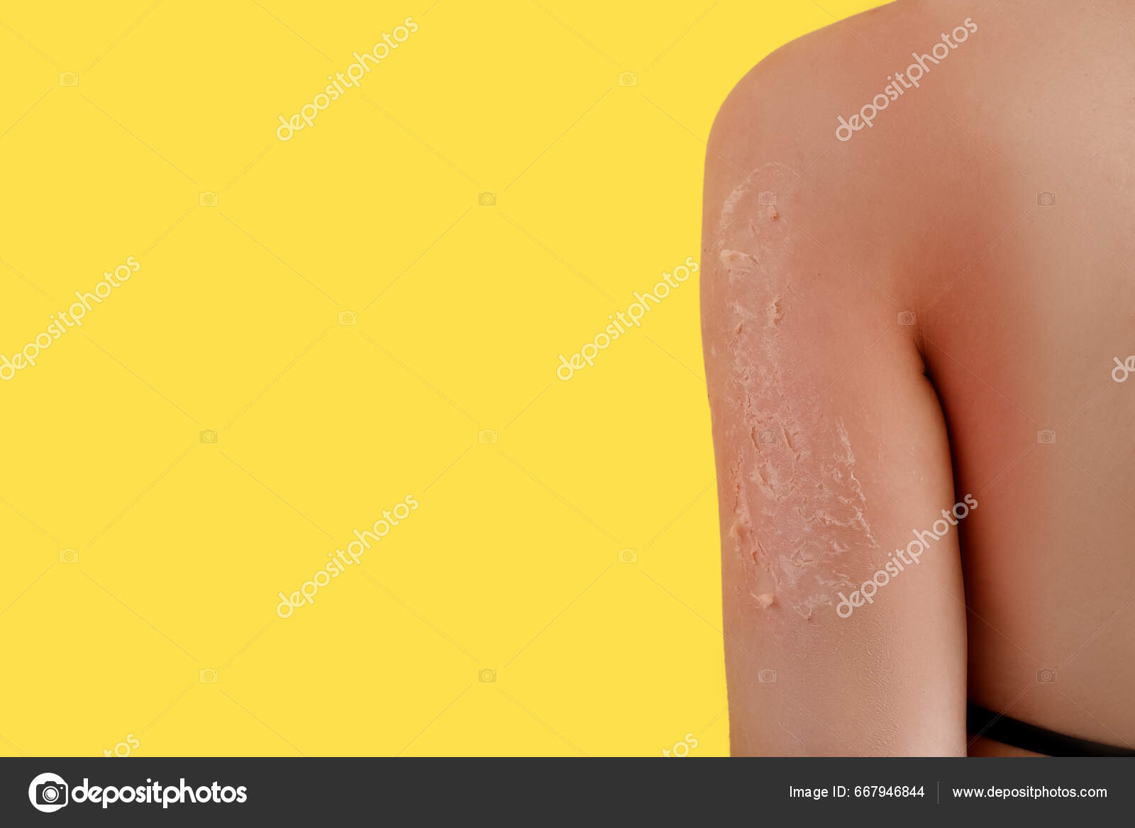 Mujer Joven Alérgica Con Piel Quemada Por Sol Sobre Fondo — Foto de stock © serezniy #667946844