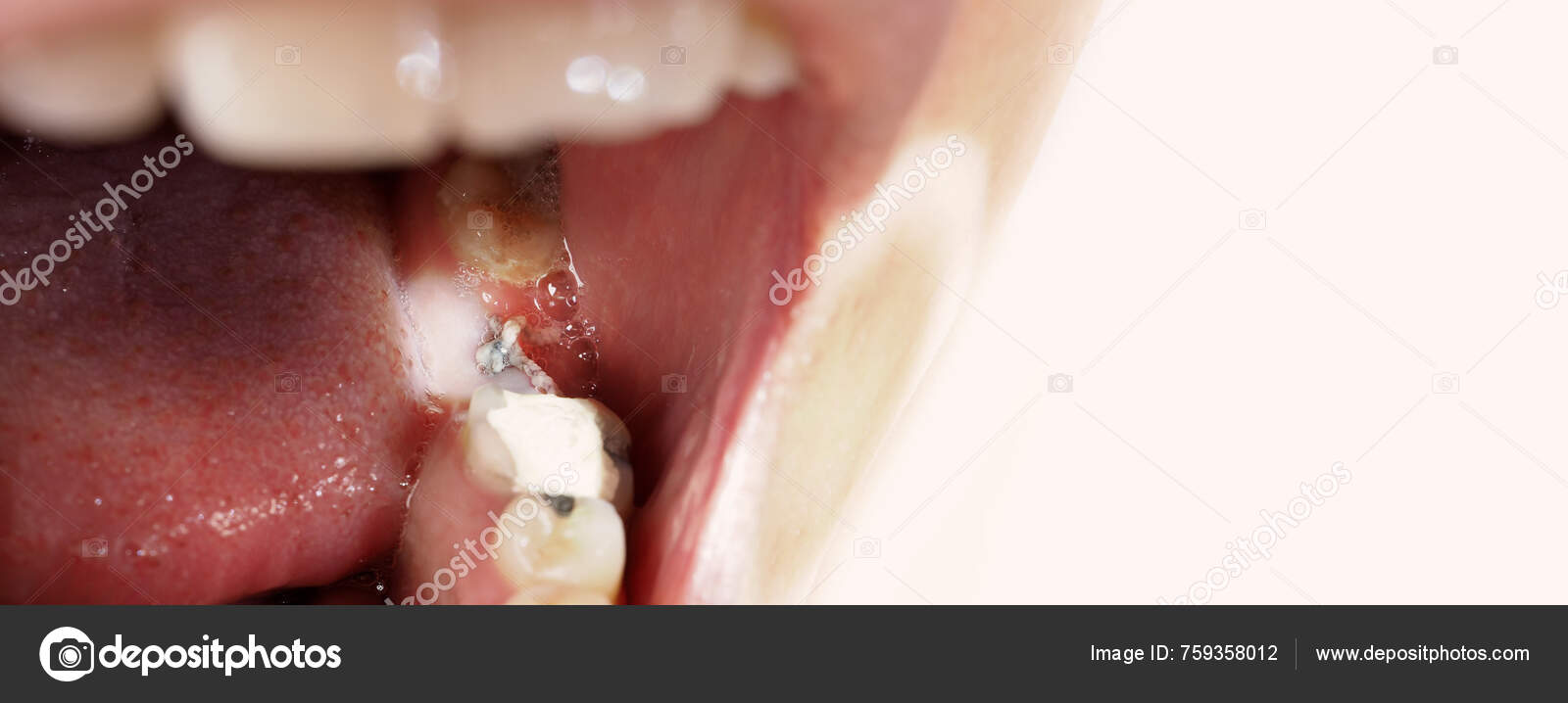 Close Suture Gum Surgery Molar Extracted Wound Closed Stitches Adjacent ...