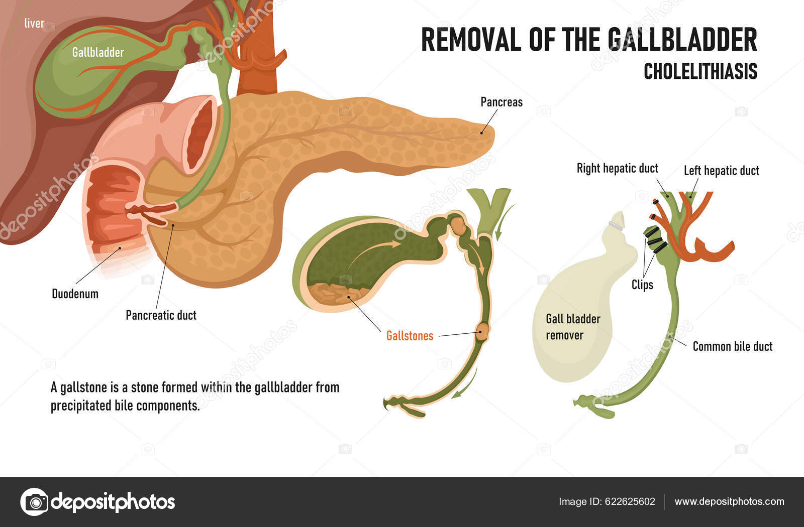 Cholécystite Inflammation Vésicule Biliaire Des Voies Biliaires Pierres ...
