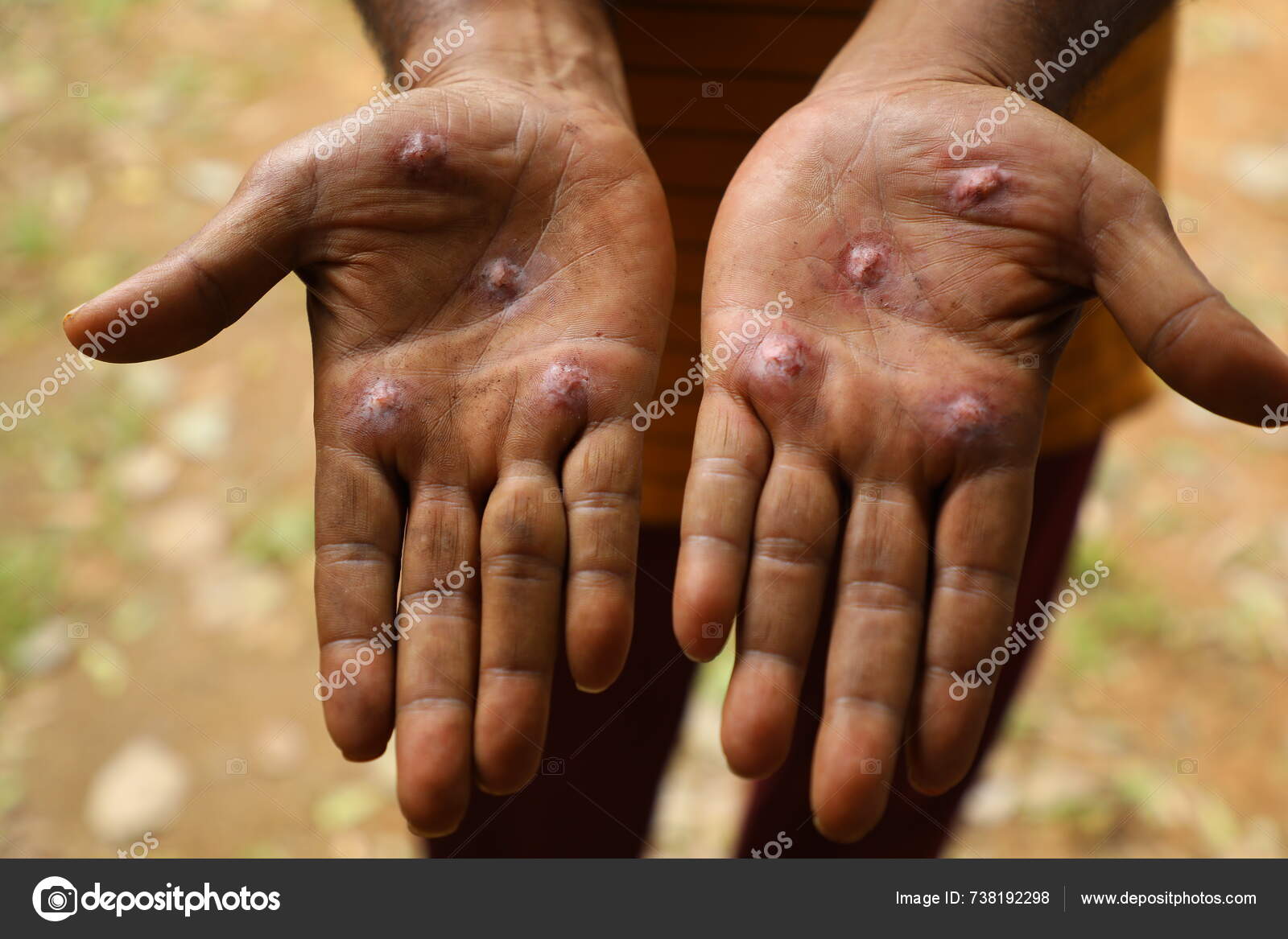 Hand Corns Callosities — Stock Photo © rajastills #738192298