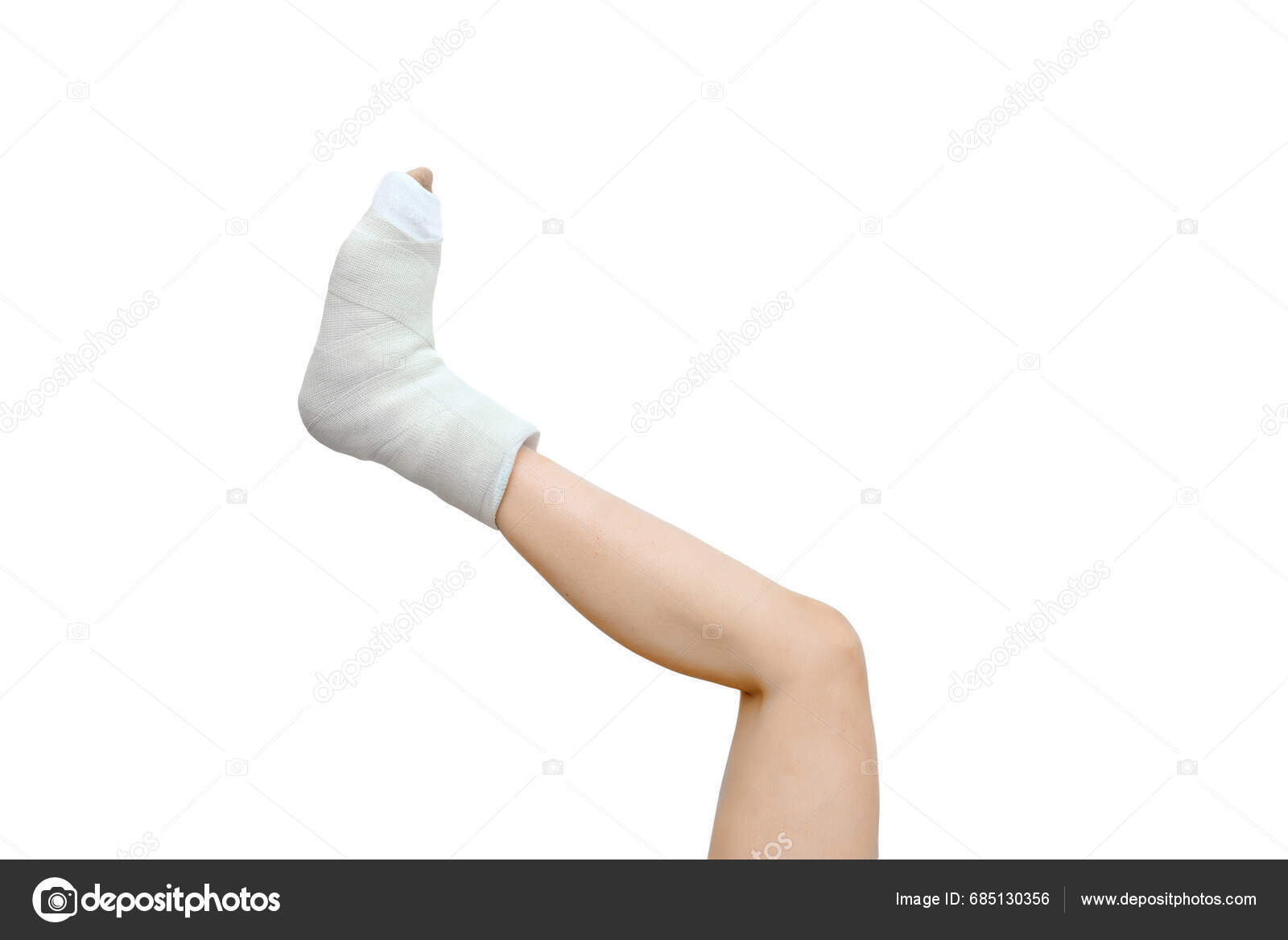 Closeup Photo Broken Female Leg Elbow Crutches Orthopedic Plaster White ...