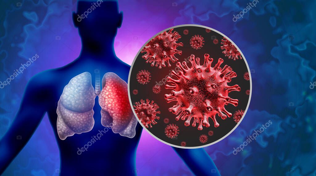 Brote de neumonía Virus patógeno Infección pulmonar e infecciones ...
