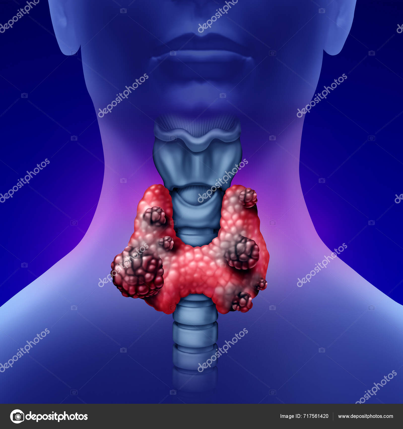 Cancer Thyroid Gland Concept Human Organ Malignant Tumor Growth Symbol ...