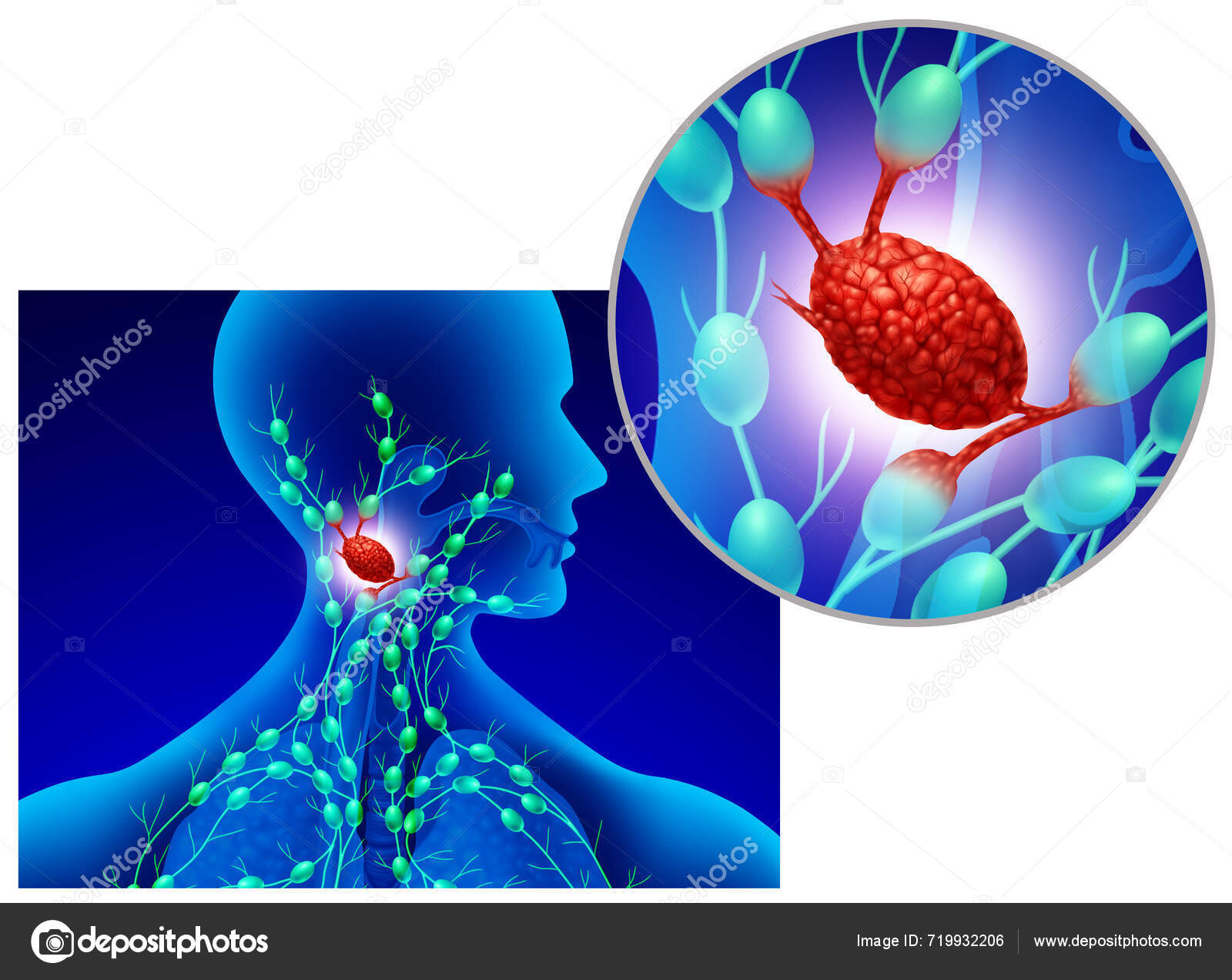 Node Lymph Bengkak Sebagai Kelenjar Yang Terinfeksi Dari Sistem ...