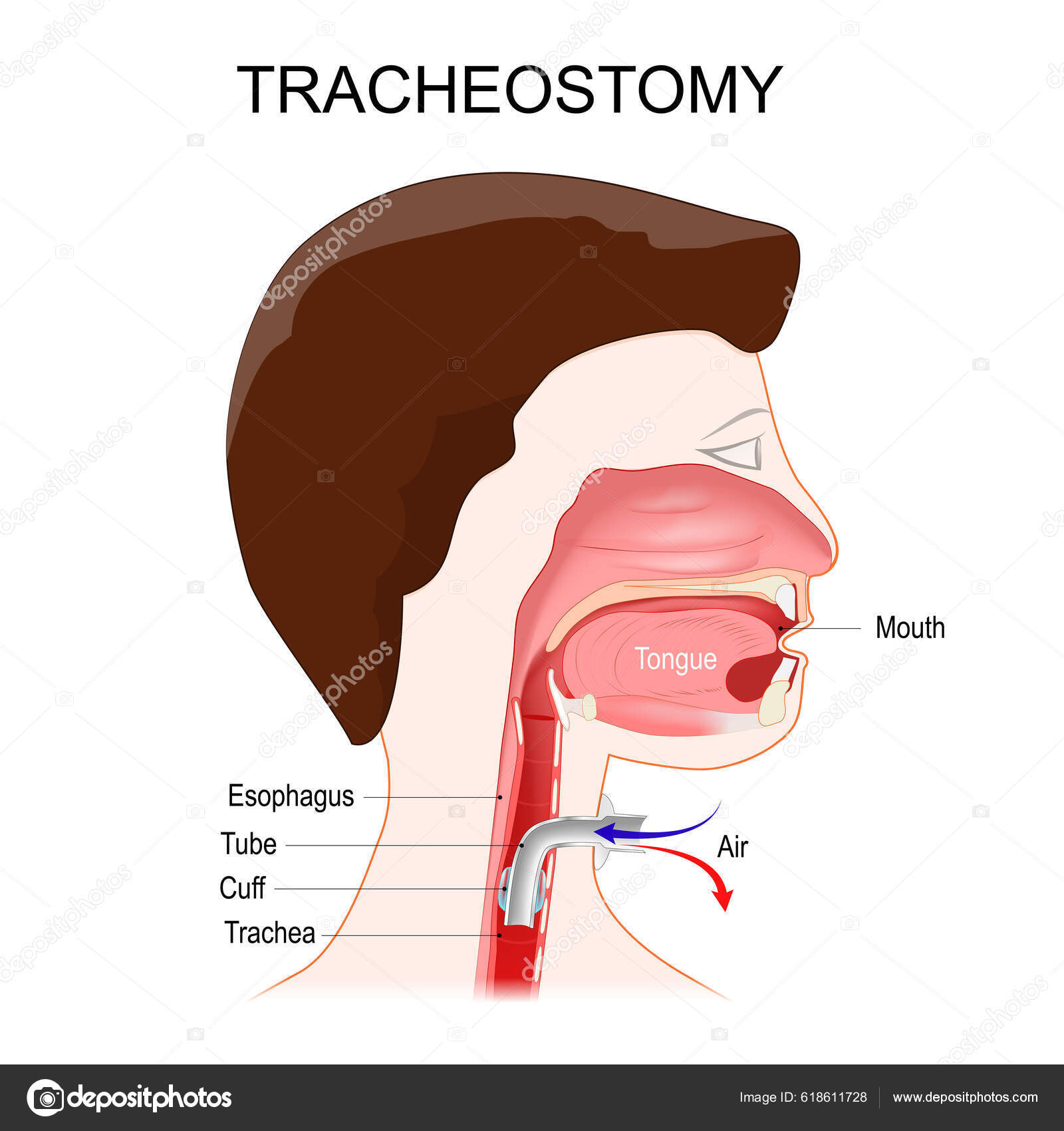 Traqueotomía Vista Lateral Del Cuello Colocación Correcta Tubo