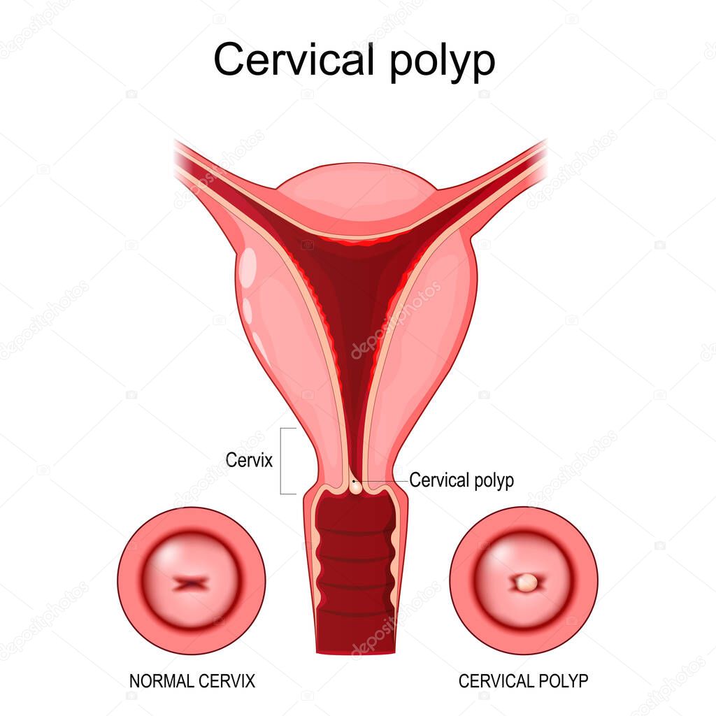 Pólipo cervical. Sección transversal de un útero humano. Cérvix normal y tumor benigno en la ...