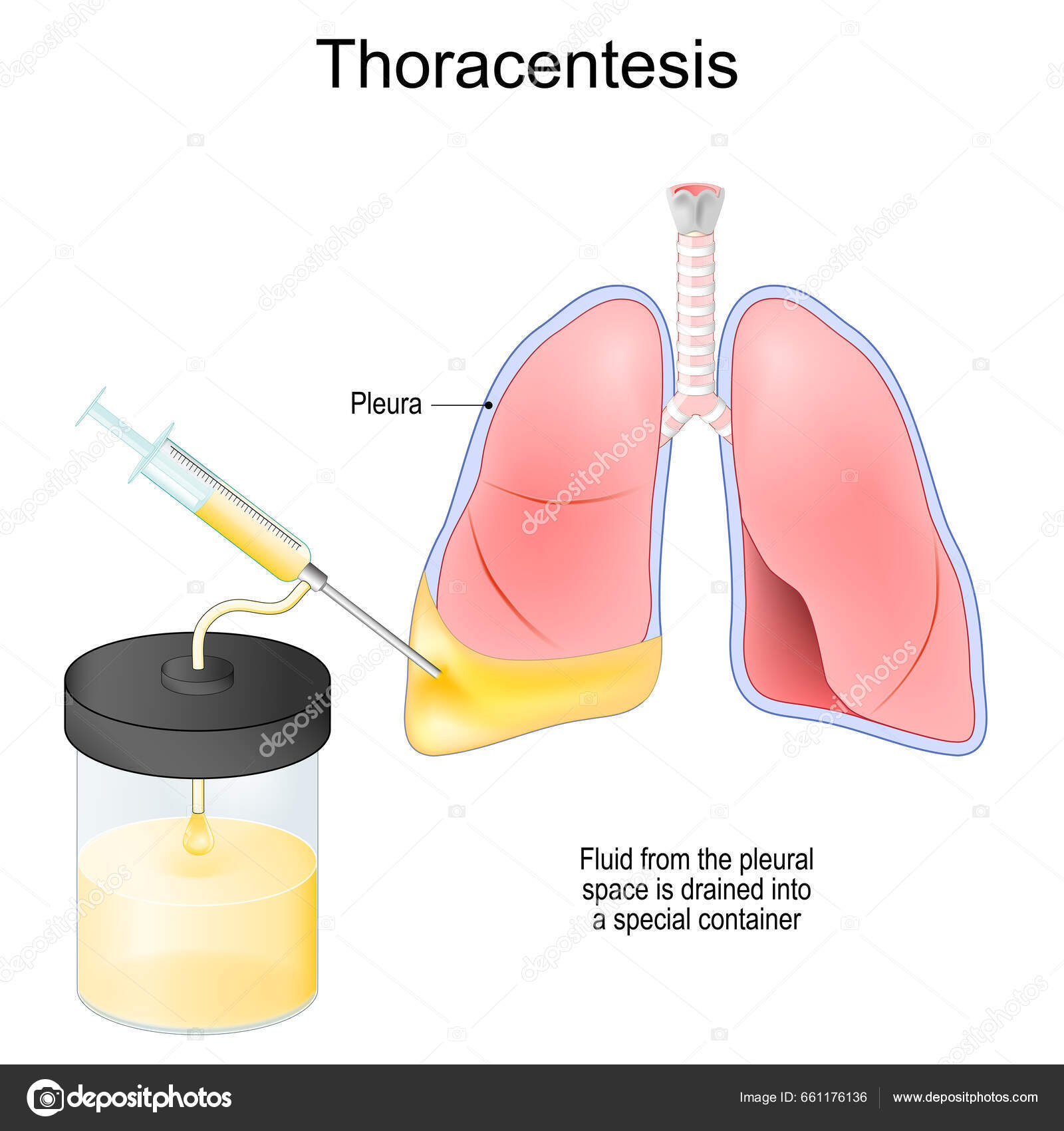 Etapas Do Procedimento De Toracocentese