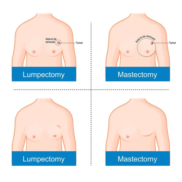 Vectores de Mastectomia, imágenes vectoriales | Depositphotos