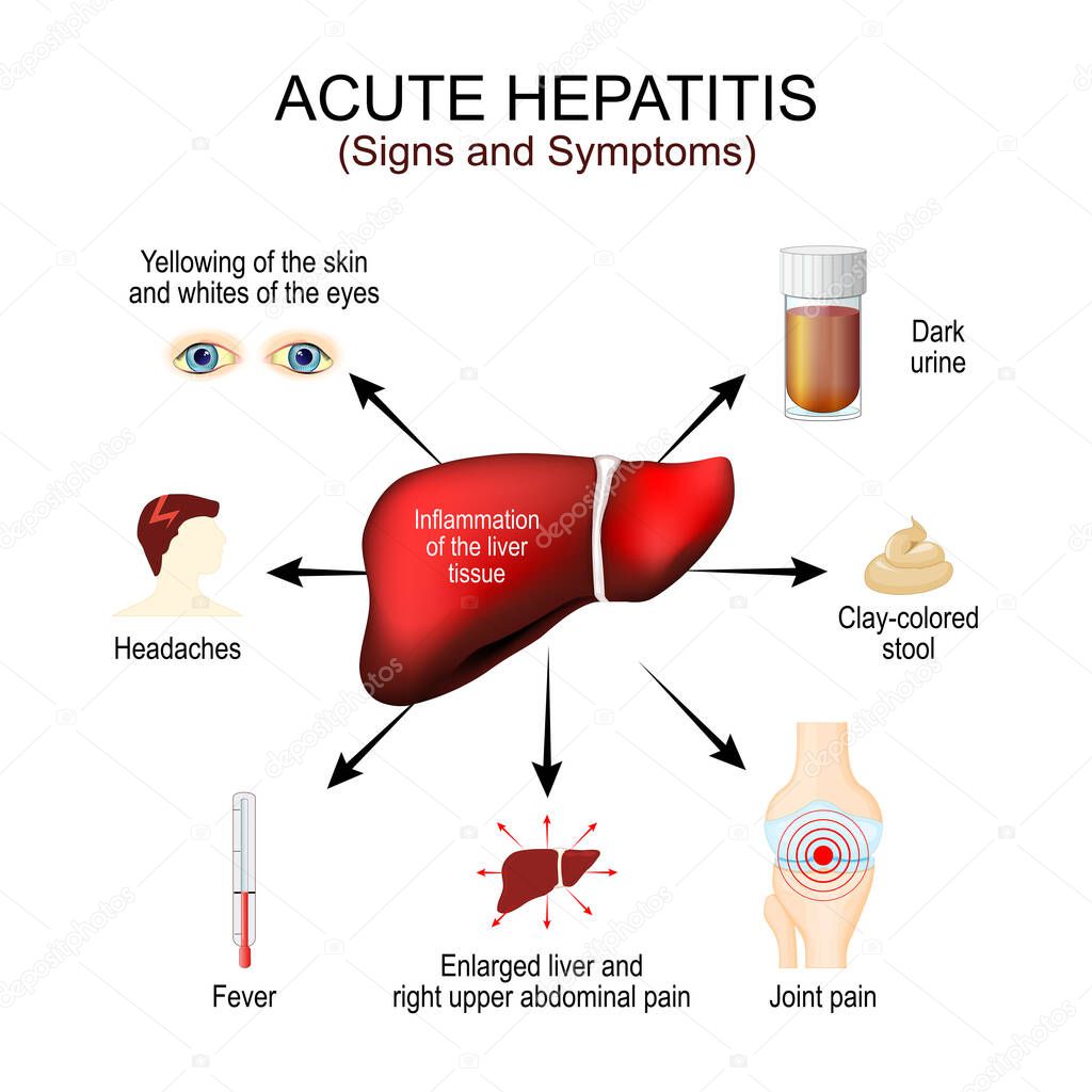hepatitis aguda. Signos y síntomas de la enfermedad hepática viral ...