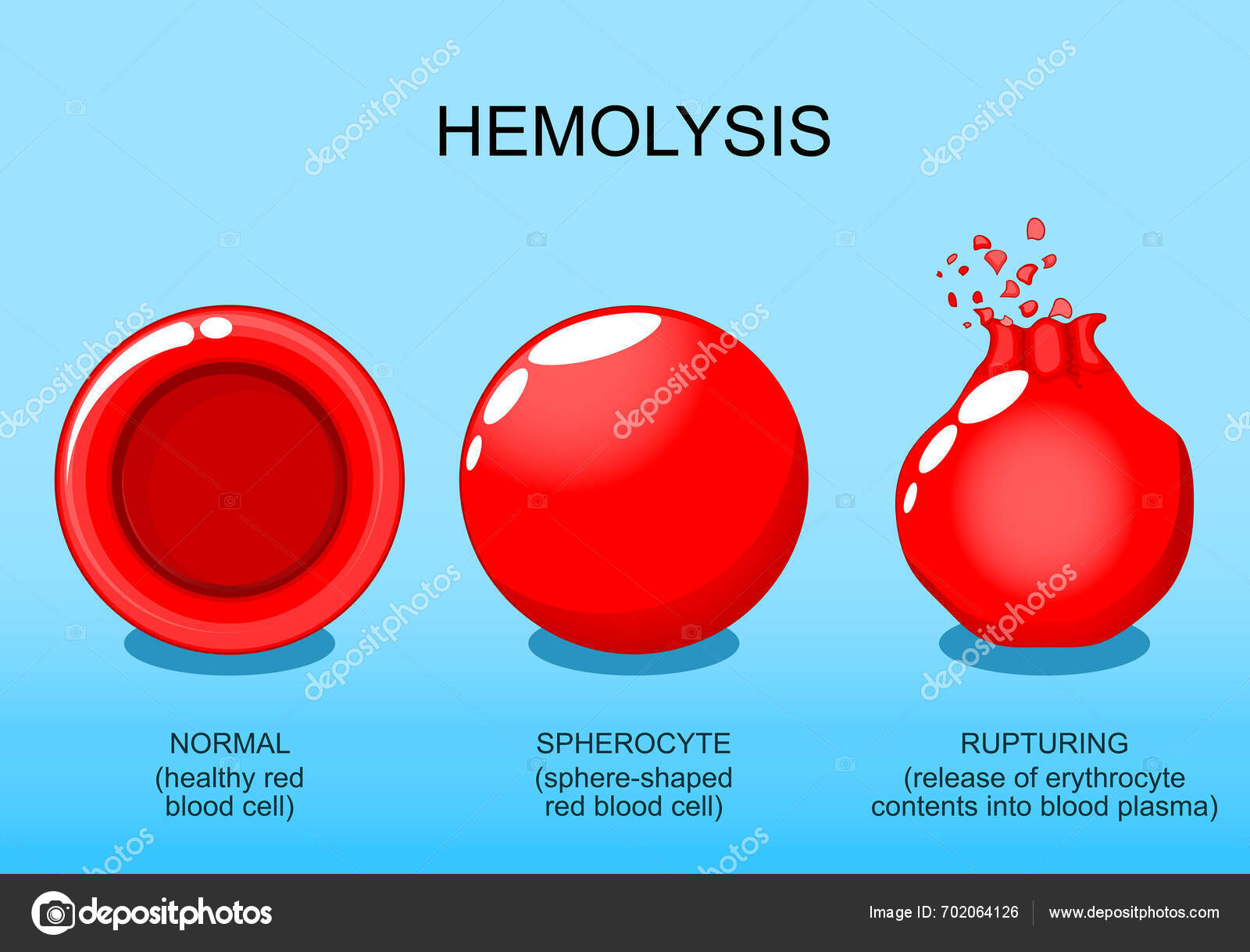 Hemolysis Normal Red Blood Cell Spherocyte Rupturing Erythrocyte ...