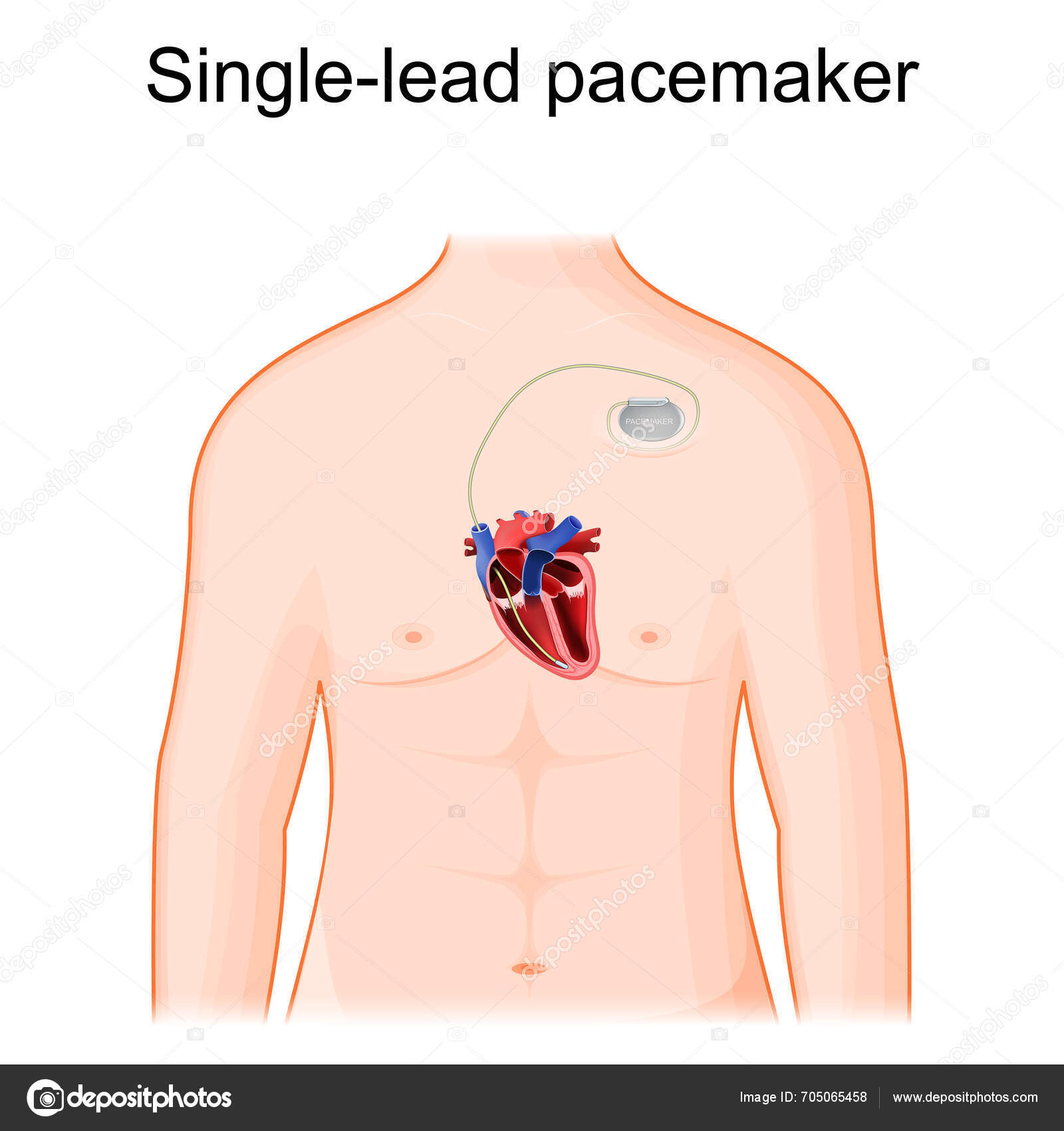 Single Lead Pacemaker Placement Human Body Cross Section Hert Artificial Stock Vector by ...