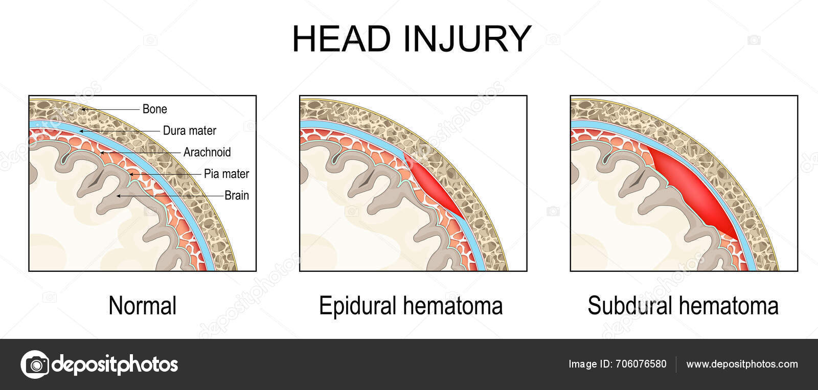 Epidural Hematom Och Subduralt Hematom Traumatisk Hjärnskada Tvärsnitt ...