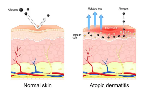 Dermatitis atopik Vektor Stok, Ilustrasi Dermatitis atopik Bebas ...