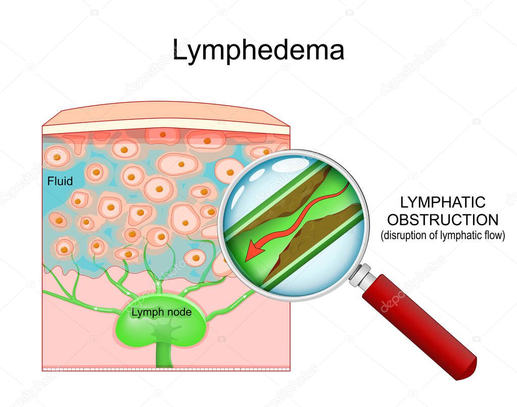 Lymphedema. Cross section of a human skin, and Lymph node. A lymphatic ...