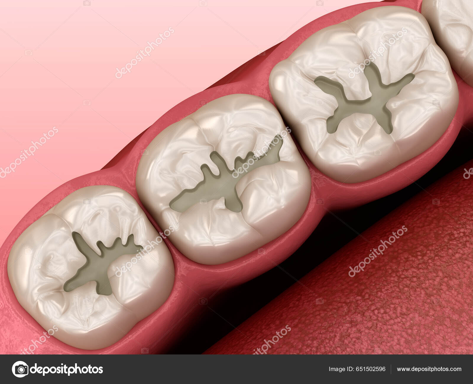 Prepareted Molar Fissure Fillings Placement Dental Illustration — Stock ...