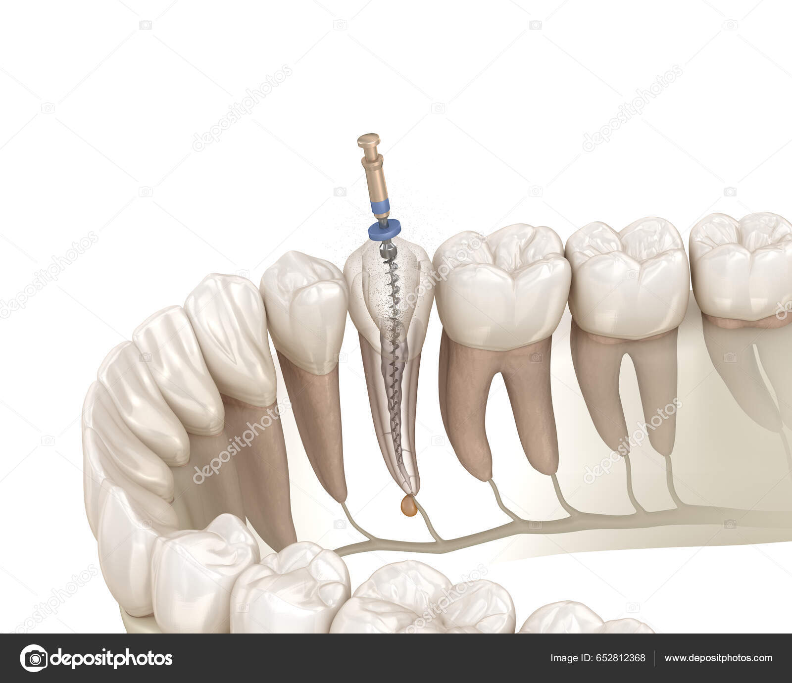 Tratamiento Endodóntico Del Conducto Radicular Ilustración Dientes ...