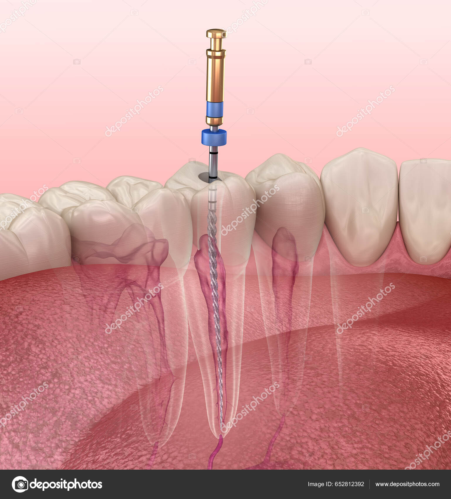 Endodontic Root Canal Treatment Process Medically Accurate Tooth ...