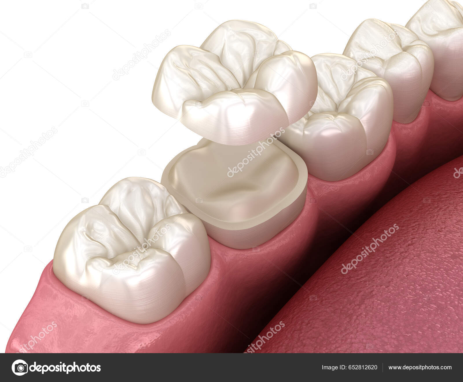 Onlay Ceramic Crown Fixation Tooth Medically Accurate Illustration ...