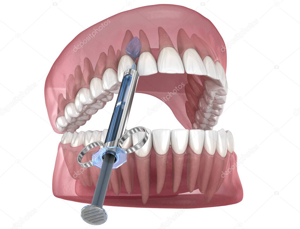 Anestesia dental local. Ilustración 3D del tratamiento dental 2024