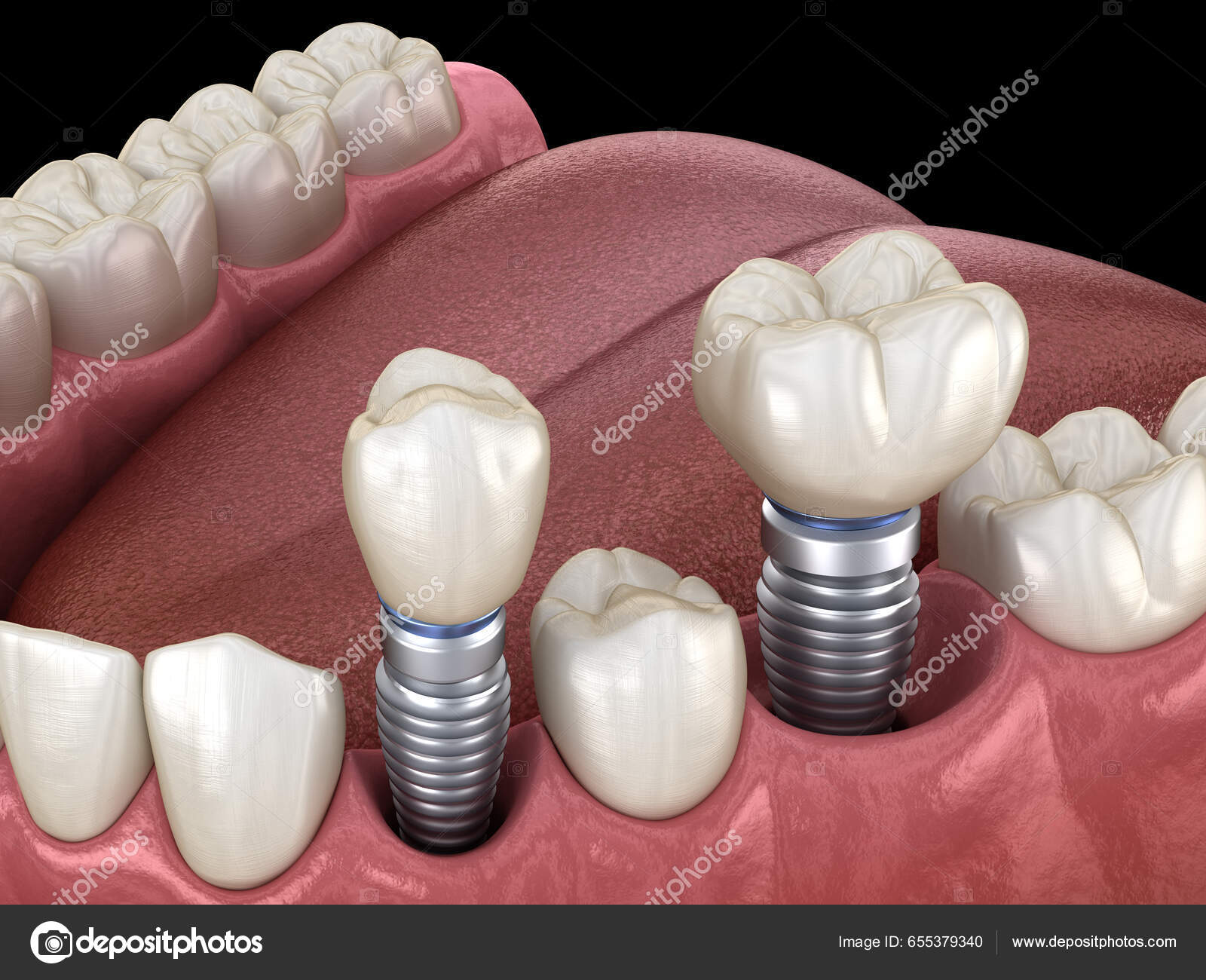 Premolar Molar Tooth Crown Installation Implant Screw Fixation ...