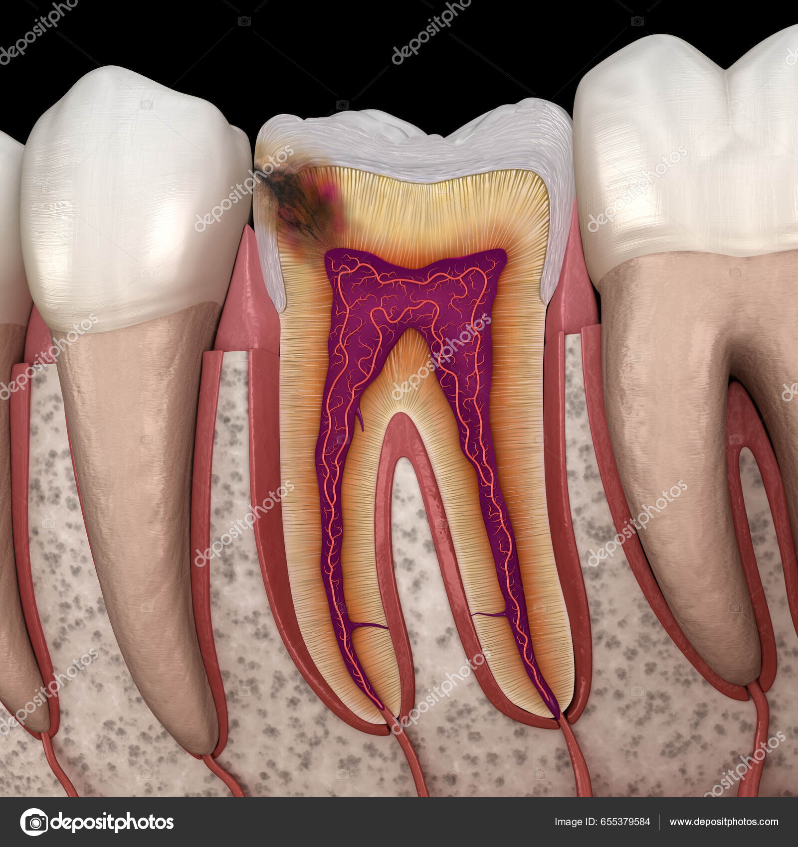 Caries Oculta Diente Molar Ilustración Médicamente Precisa: fotografía ...