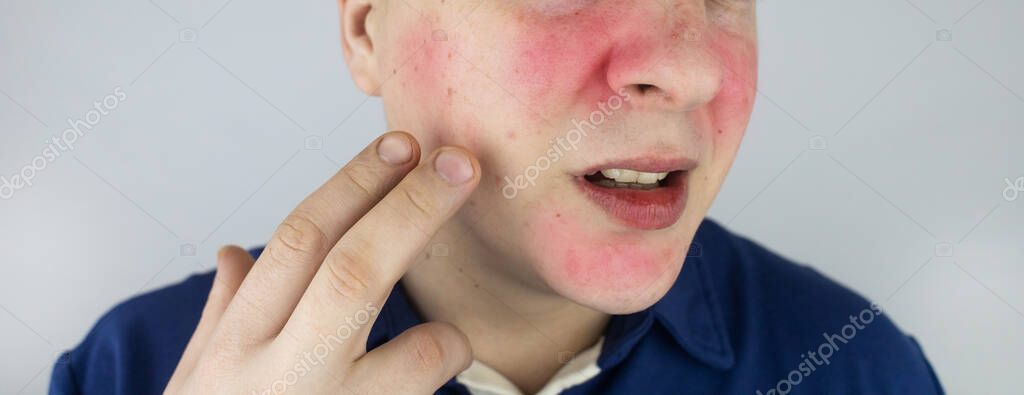 Rosacea face. The man suffers from redness on her cheeks. Couperose of ...