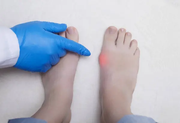 Hallux valgus, deformación del dedo gordo del pie. Médico ortopédico ...