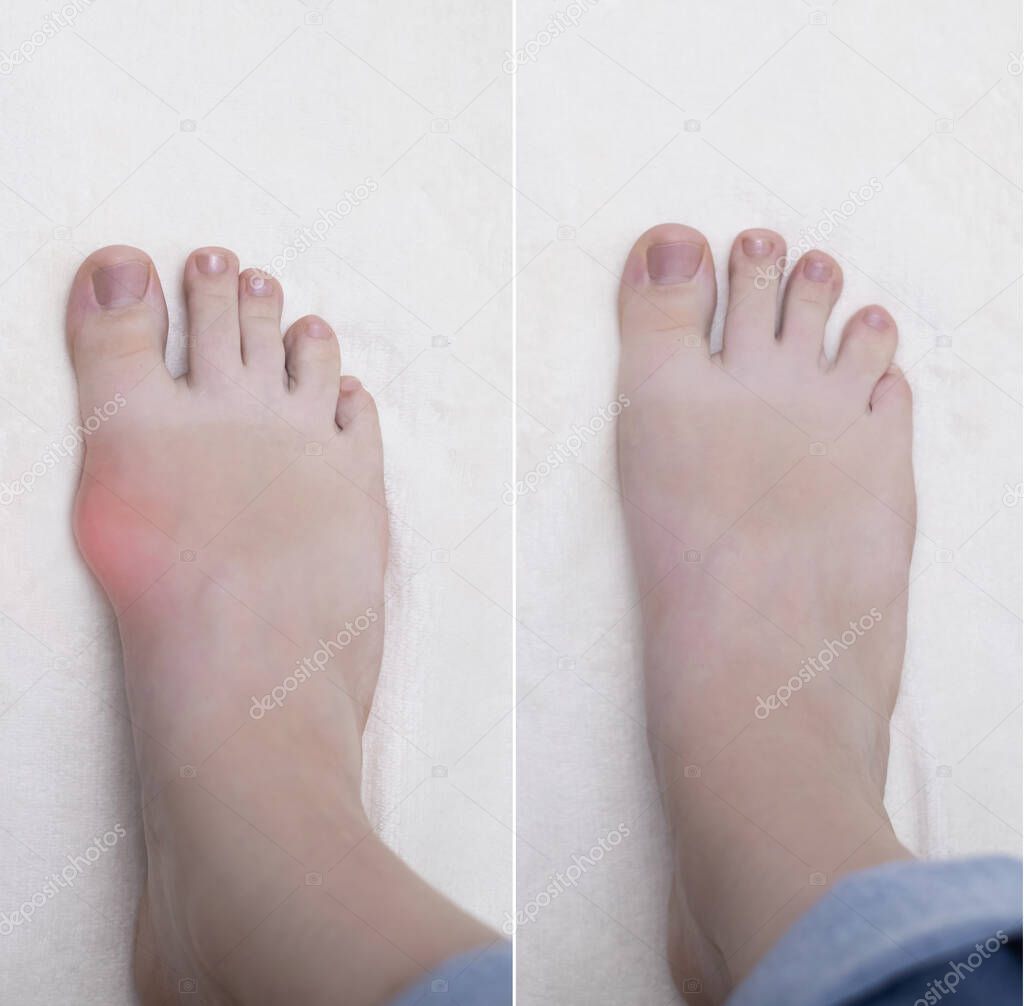 Hallux valgus, deformación del dedo gordo del pie. Médico ortopédico ...