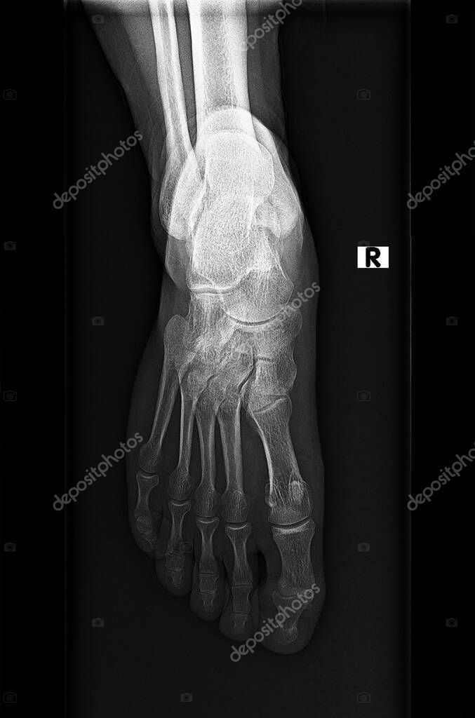 Radiografía normal, radiografía o radiografía del pie y la articulación ...