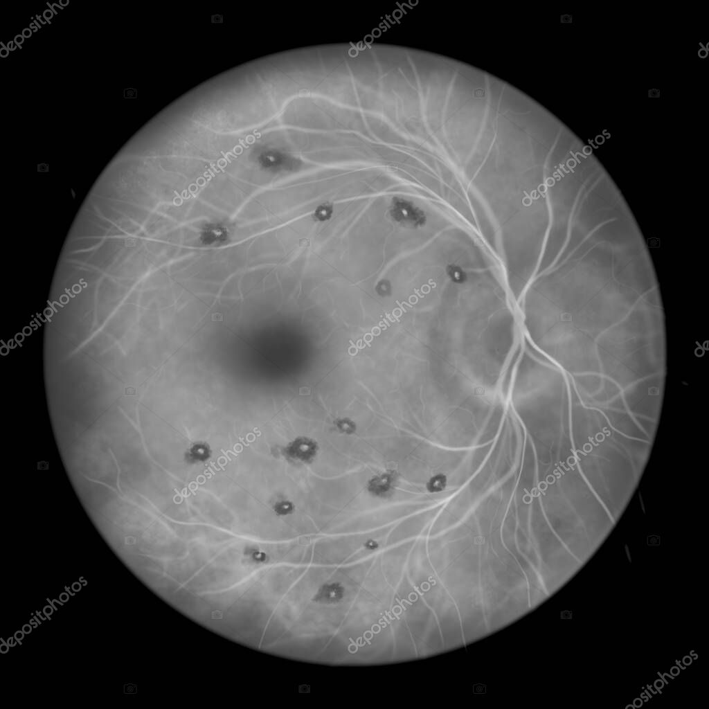 Ilustración de manchas de Roth en la retina observadas en la ...