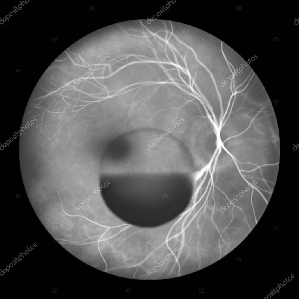 Ilustración de una hemorragia subhialoide en la retina como se observó ...