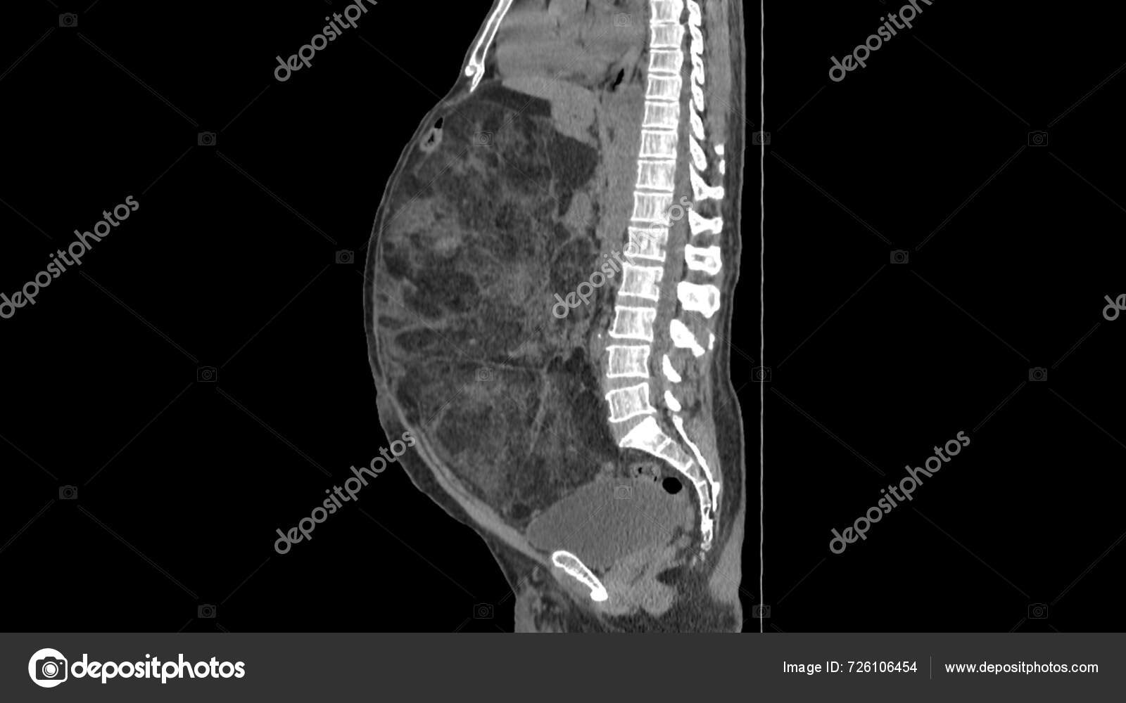 Computed Tomography Scan Abdomen Patient Large Liposarcoma Dark Centre ...