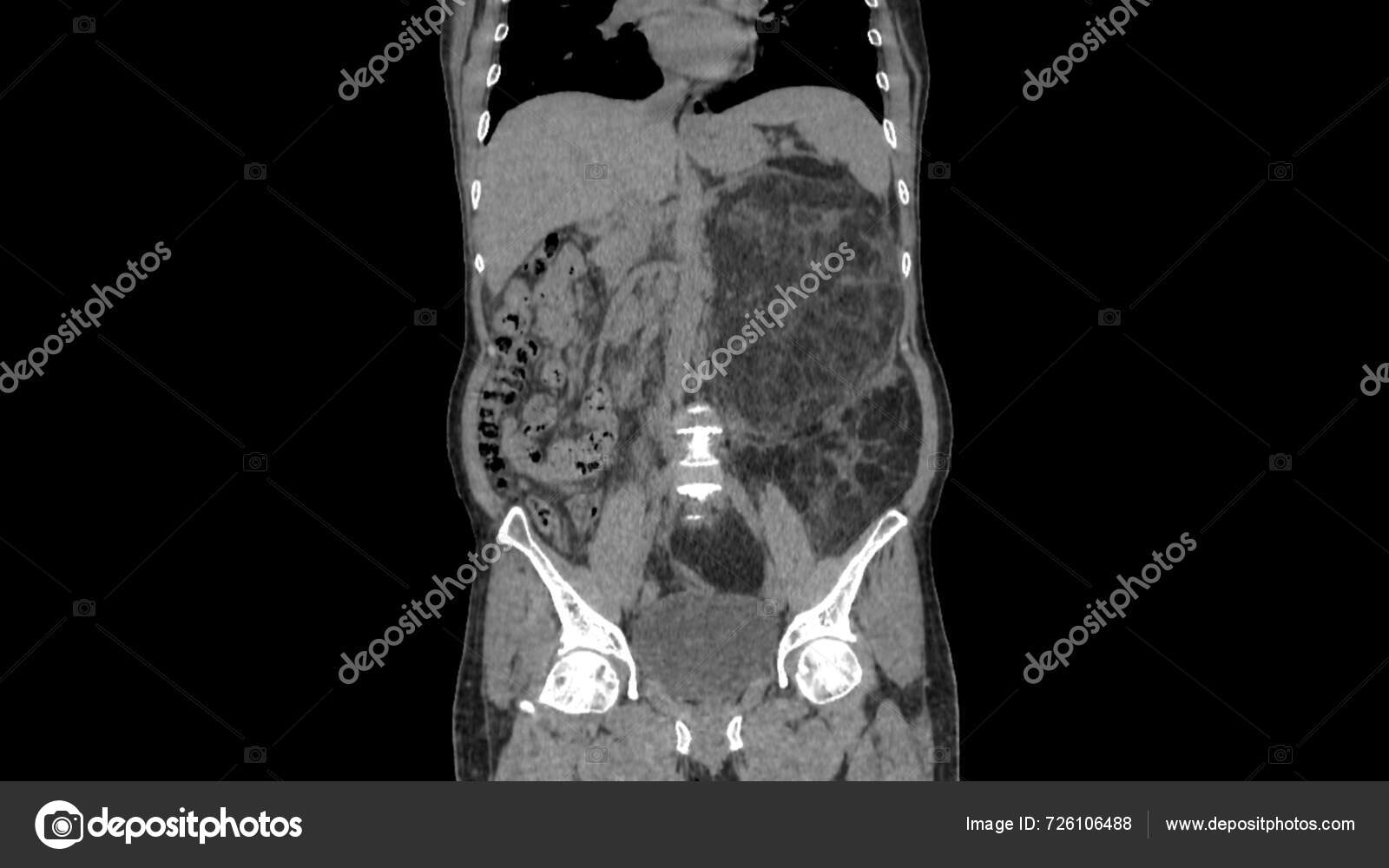 Computed Tomography Scan Abdomen Patient Large Liposarcoma Right ...