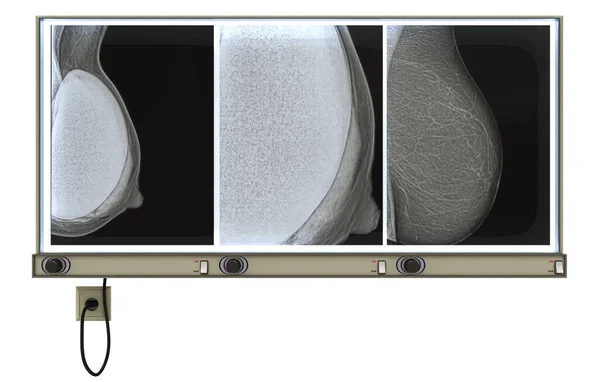 Mammography x ray Stock Photos, Royalty Free Mammography x ray Images ...