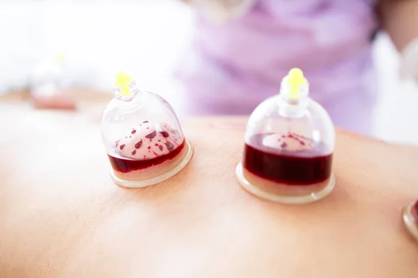Vista de cerca de las tazas de terapia de hijama llenas de sangre como ...