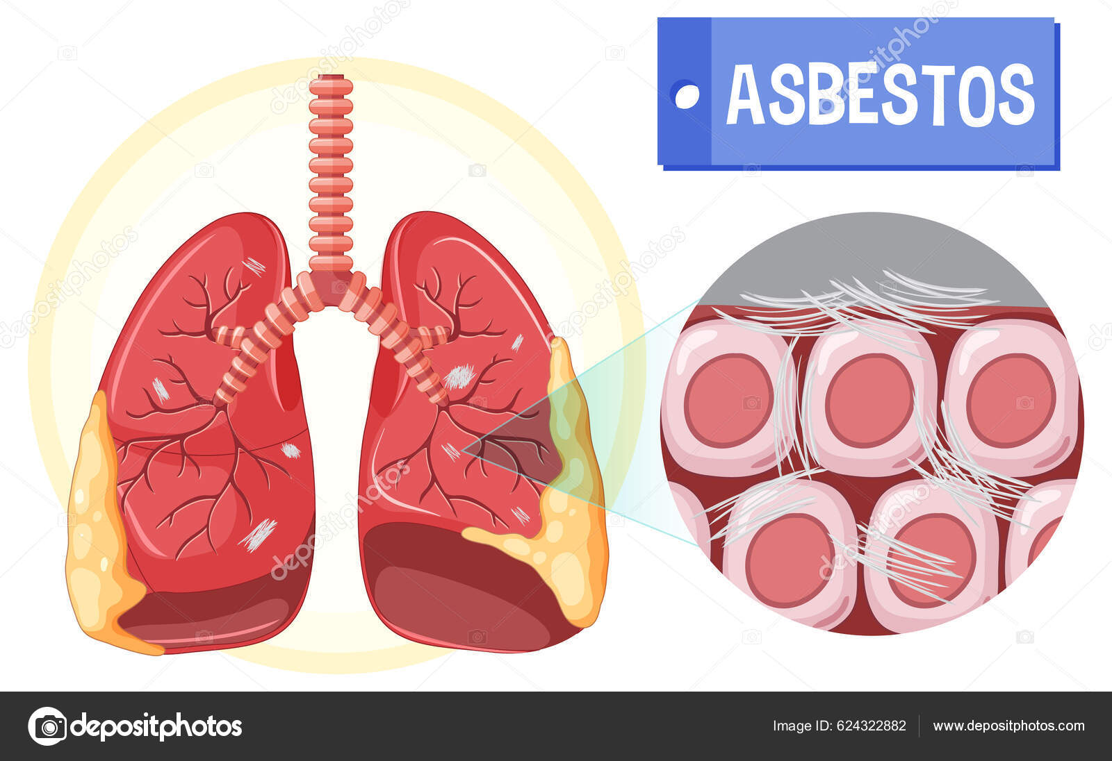 Diagram Showing Asbestosis Lungs Illustration Stock Vector by ...